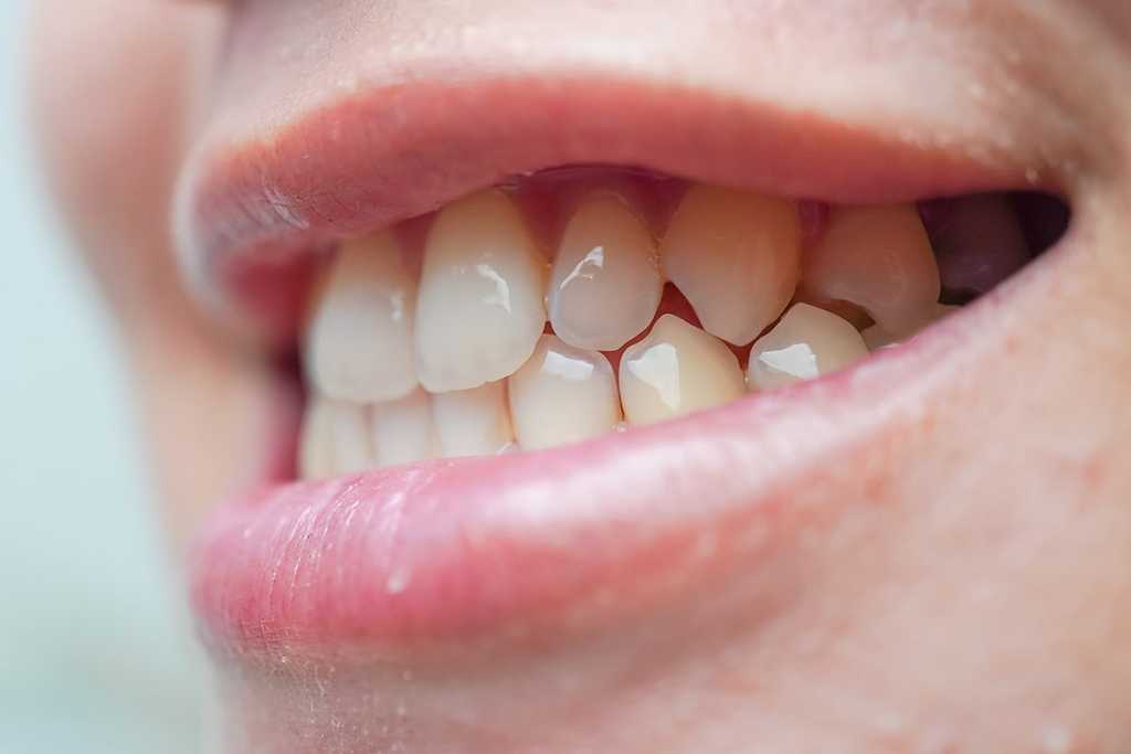 Understanding "Soft Teeth": What You Need to Know