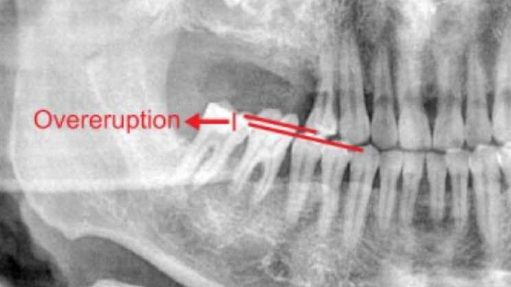 What is “Super-Eruption” Tooth?